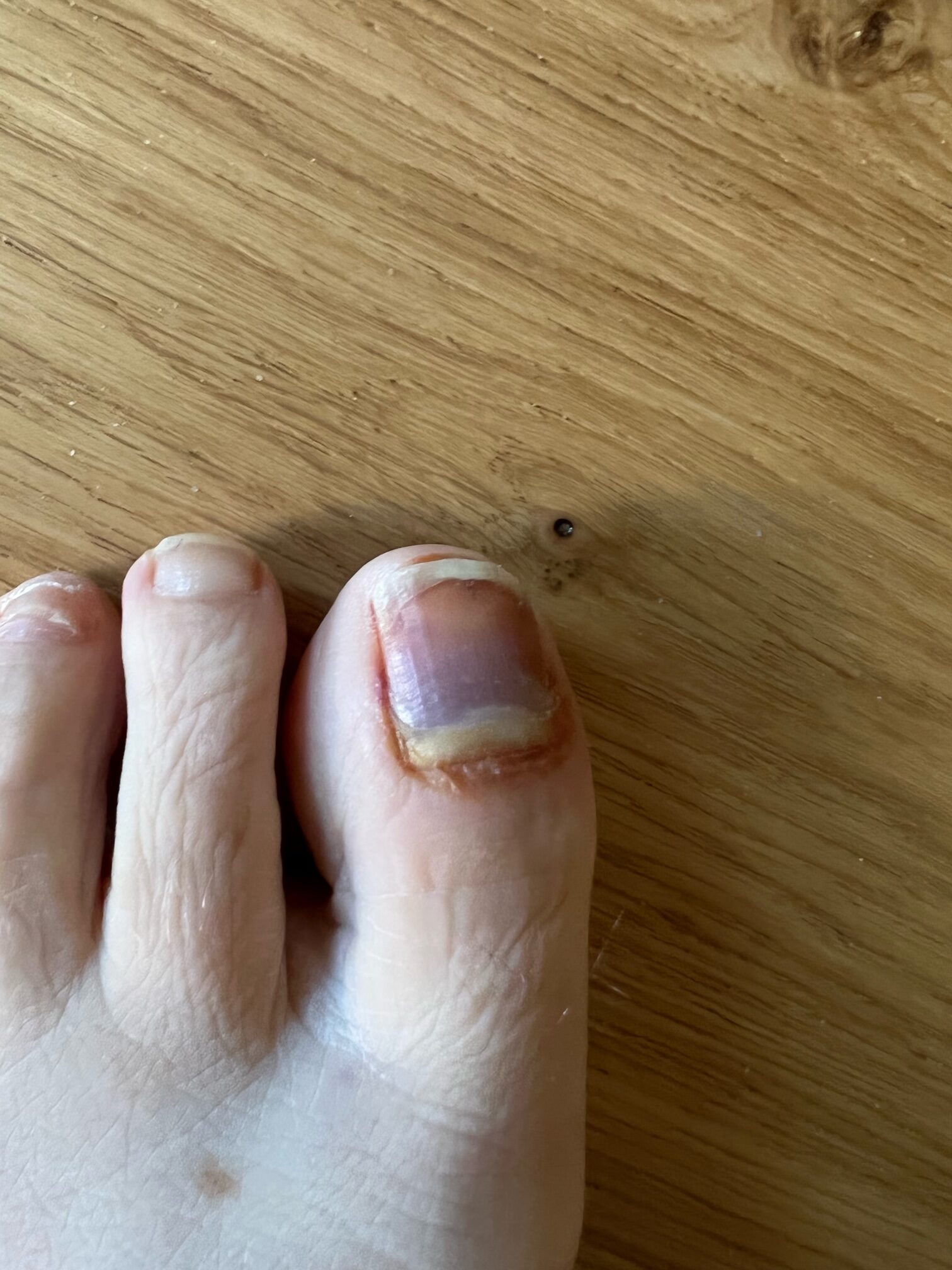 Walking Injuries – janjanjan